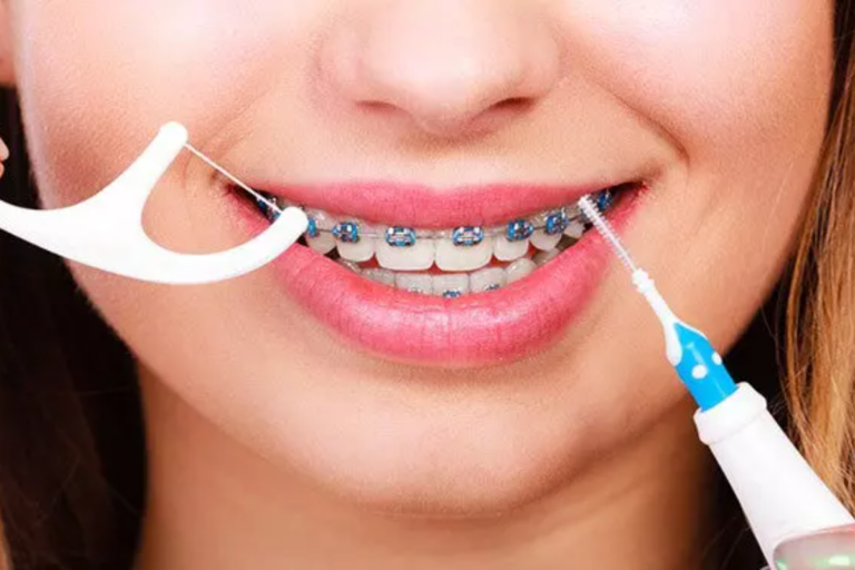 How to Keep Your Braces Clean and Your Breath Fresh | Expert Tips