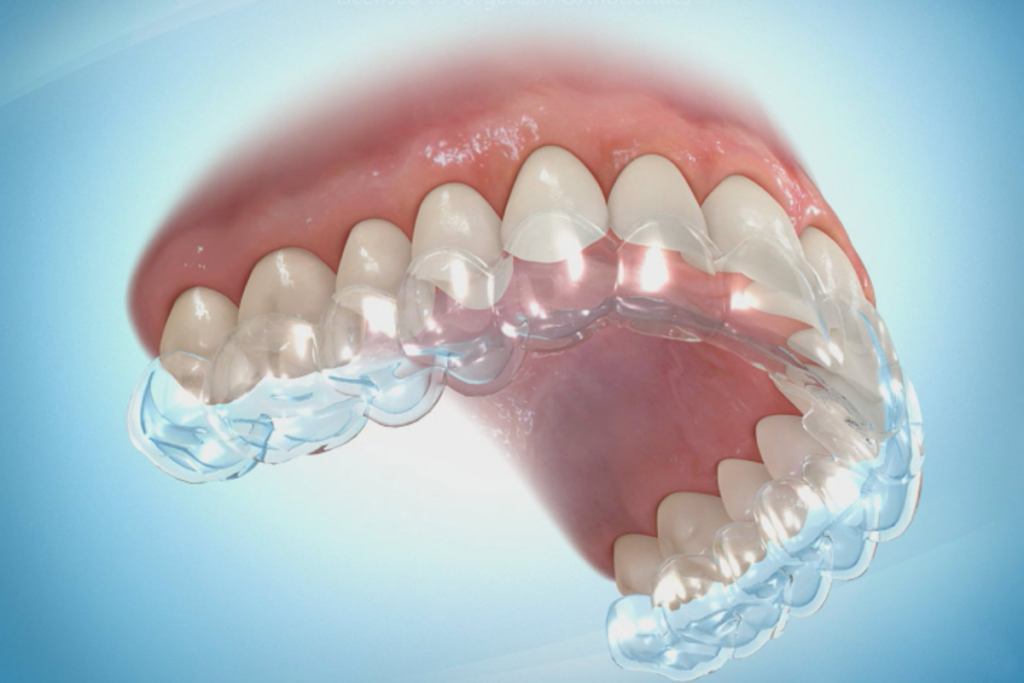How Long Should You Wear a Retainer After Braces or Invisalign?